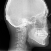 Cephalometric Analysis | Cephx